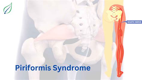 Understanding Piriformis Syndrome Causes Symptoms And Treatment