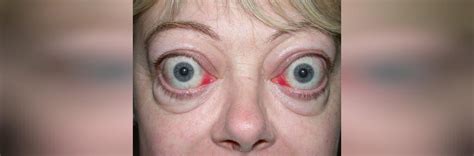 فشار و درد در پشت چشم علل، علائم، راه تشخیص و درمان درد کاسه چشم