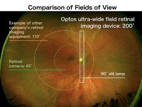 Understanding Optos® Fundus Photo Advanced Retinal Imaging Optyx Home