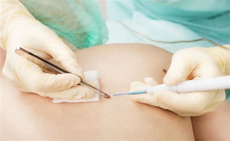 What Is Involved In Beauty Mark Removal With Pictures