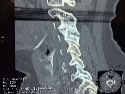 Posterior Cervical Facet Arthrosis Ppt