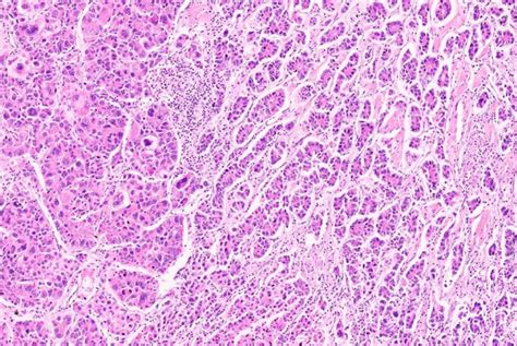 Combined Hepatocellular Cholangiocarcinoma A Clinicopathological Update PMC