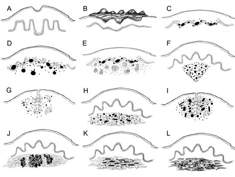 Signature Nevi Individuals With Multiple Melanocytic Nevi Commonly Have Similar Clinical And Signature Nevi Individuals With Multiple Melanocytic Nevi Commonly Have Similar Clinical And