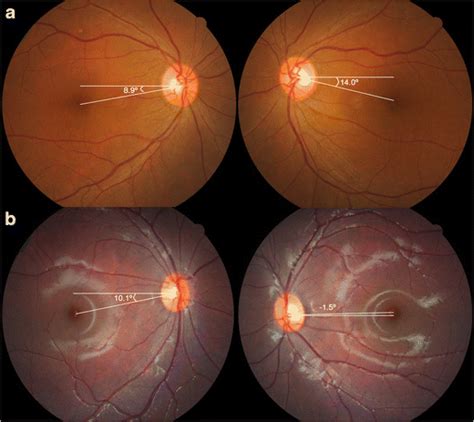 Cranial Nerve Iv Trochlear Nerve Palsy 41 Off
