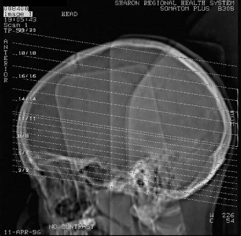 A Typical Axial Scan Pattern Note That The Scanning Direction Is At An