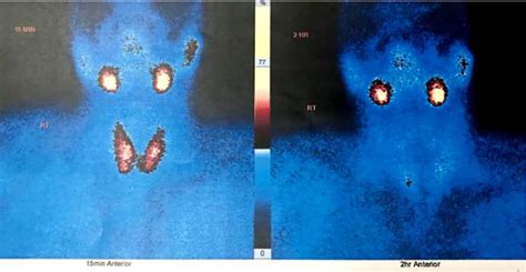 Focused Parathyroidectomy For Single Parathyroid Adenoma A Clinical