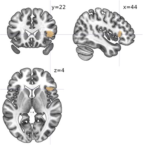 Activation Map For The Seed‐based D‐mapping With Permutation Of Subject Download Scientific