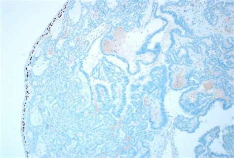 H P63 negative in the cancer cells. Positivity is within the basal ...