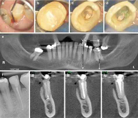 EndodonticPeriodontal Interrelationship Pocket Dentistry