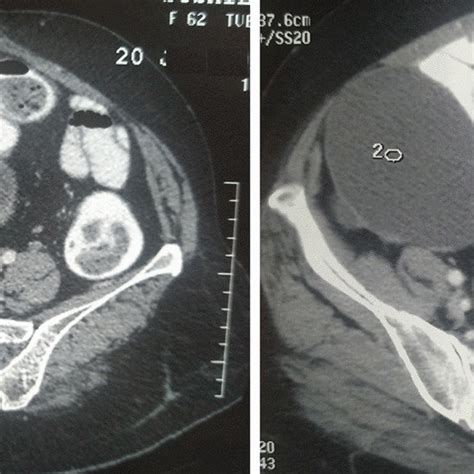 Ct Of The Abdomen After The Appendectomy Showing A Low Density Cystic Download Scientific