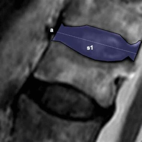 Comparison Of Pre And Post Operative Modified Pfirrmann Grading System