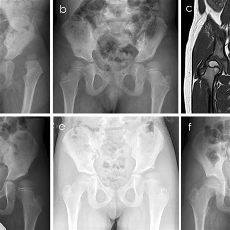 A Preoperative Pelvic Anteroposterior View In A 17 Month Old Girl On