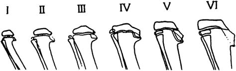 Infantile Blounts Disease Tibia Vara Pediatrics Orthobullets