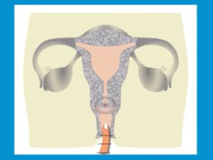 Step By Step How To Measure Cervix Length At Home Easily
