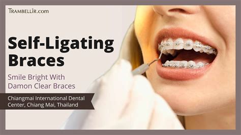 Self Ligating Braces Smile Bright With Damon Clear Braces Trambellir