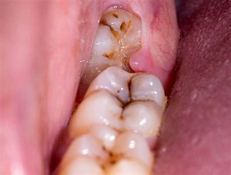 Wisdom Tooth Removal Gentle And Pain Free Tooth Extraction