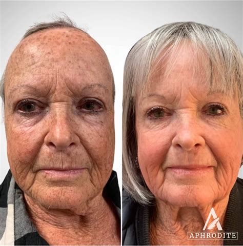 Before And After Ipl Photofacial Aphrodite Aesthetics And Wellness