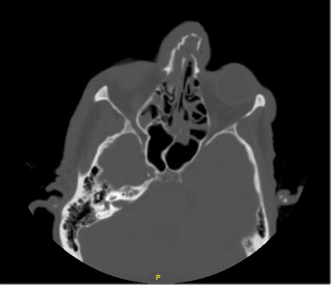 Frontal Process Of Maxilla Fracture