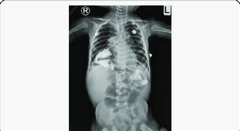 Chest X Ray Shows Coiled NGT With Contrast In The Stomach On The Right Download Scientific