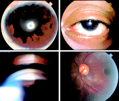 Primary Iris Pigment Epithelial Hyperplasia And Glaucoma British