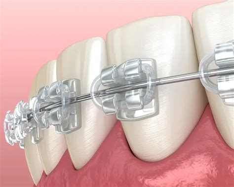 Ortodoncia Ortodoncia Digital