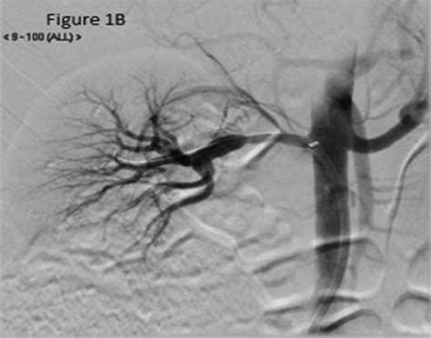 B Good Result On Final Angiogram With No Significant Stenosis