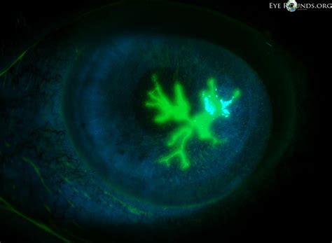 Herpes Simplex Virus Hsv Geographic Epithelial Keratitis