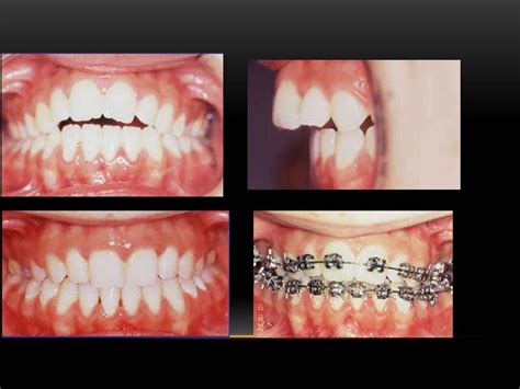 Class Ii Malocclusion Correction With Invisalign Is It Possible Clair