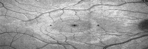 eye movements during saccadic and fixation tasks in patients