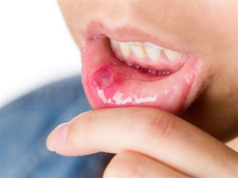 Oral Cancer Cheek