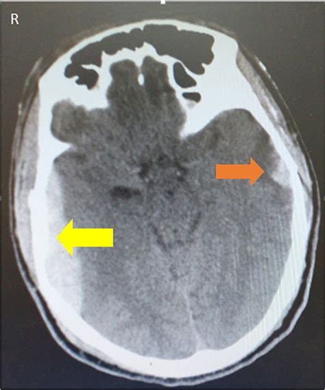 Brain Ct Scan Showing Left Frontal Epidural Hematoma Yellow Arrow
