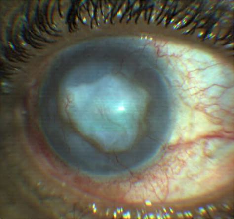 Bullous Keratopathy Cat Treatment