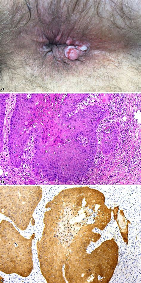 Early Stage Anal Tumor