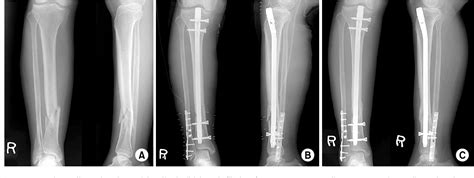 Figure 2 From Intramedullary Nailing Of Distal Tibial Fractures With