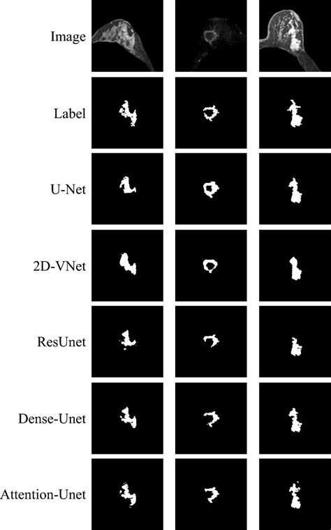Partial Segmentation Of Breast Tumor Lesions Using The U Net 2d Vnet