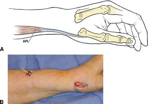 Basal Thumb Joint Replacement At Rickey Szymanski Blog