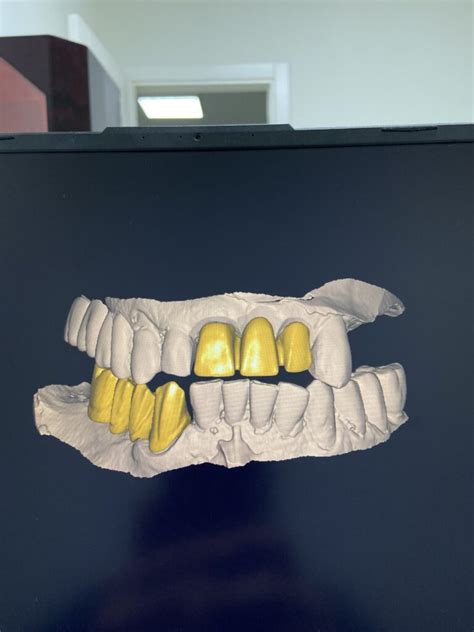 Exocad tasarım yapılır stl Dentalkariyer
