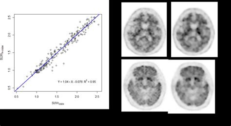 Effects Of Bayesian Penalized Likelihood Reconstruction On 11c Pittsburgh Compound B Time Of