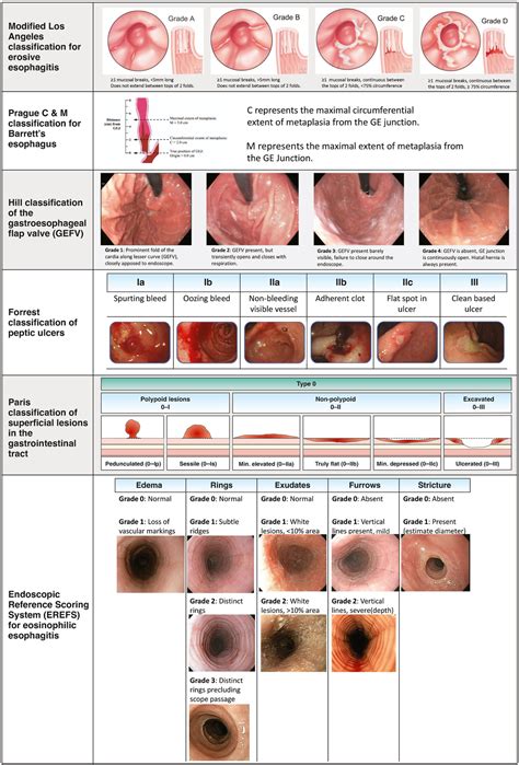 Nine Tips To Improve Your Upper Endoscopy Exams American