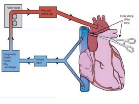 Cabg Pptx