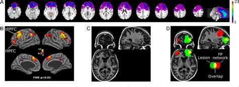 Figure 2 From Lesions To The Fronto Parietal Network Impact Alpha Band