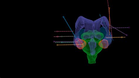 Functional Neurosurgery Planning Solutions Brainlab