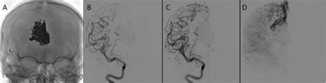 After Stage 5 Embolization 20 0 Ml Onyx A Unsubtracted Image Of The Download Scientific