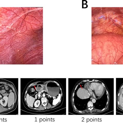 Nomogram For Predicting Occult Peritoneal Metastasis In Progressive Download Scientific Diagram