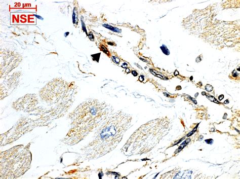 Positive Expression Of Neuron Specific Enolase Nse In The Posterior Download Scientific