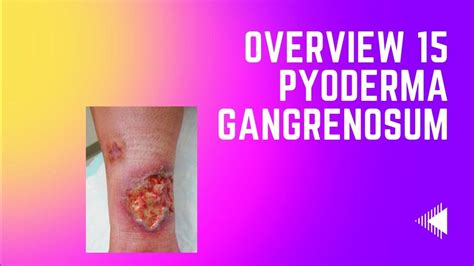 Overview 15 Pyoderma Gangrenosum Youtube