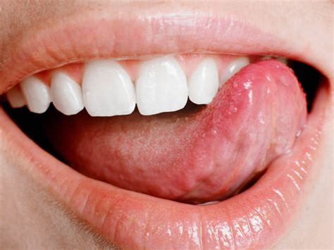 How To Get Rid Of A Pimple On The Tongue Flash Uganda Media