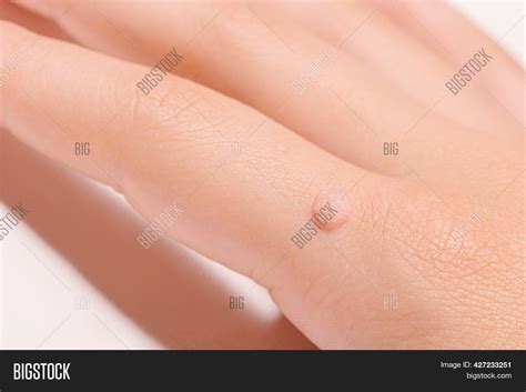 Common Wart Verruca Image Photo Free Trial Bigstock