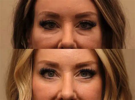 Lower Blepharoplasty Eyelid Surgery — Barnet Dulaney Perkins Eye Center