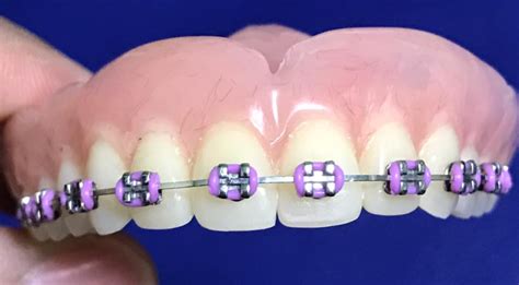 Pustiso And Retainers Express Malibay